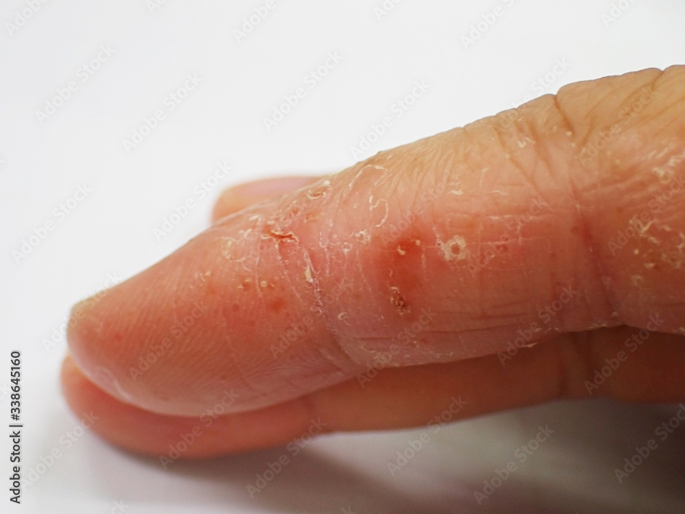 Dyshidrotic Eczema on finger close up Stock Photo | Adobe Stock