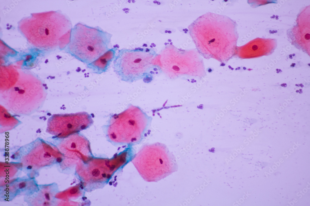 View in microscopic of Candidiasis, fungus infection (Yeast and ...