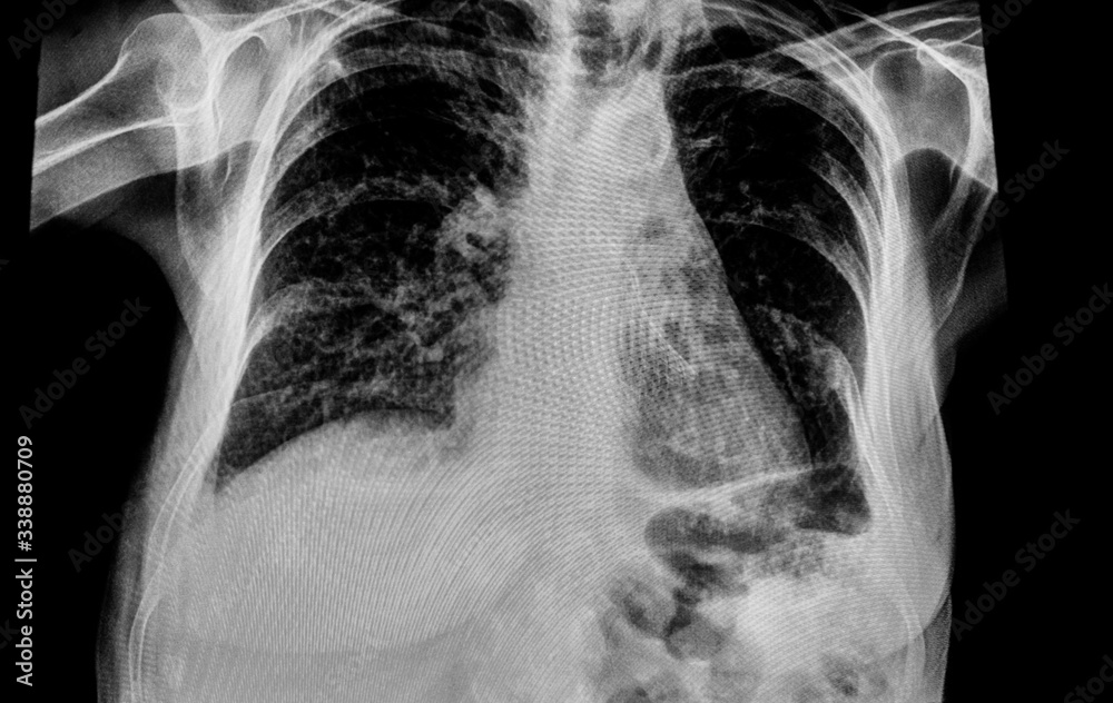 Lateral chest radiography of female patient with aortic valve ...