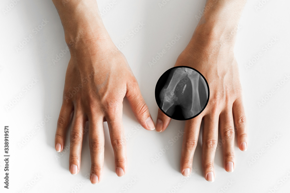 Hand with implantation of micro chip. X-Ray view close-up. Chipization ...