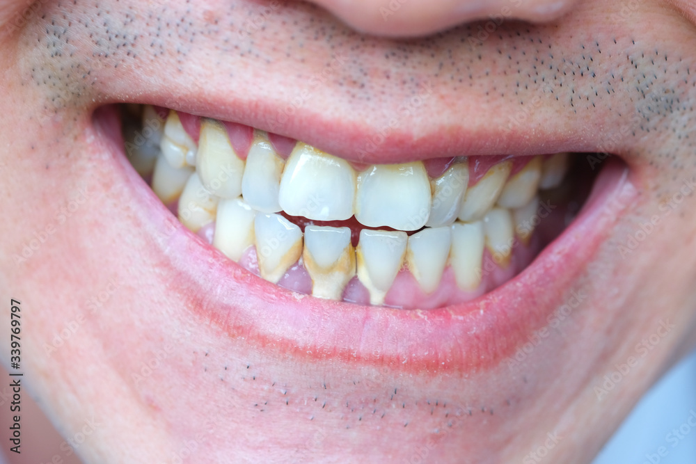 Tooth's a man smoking bad. Man smokes a cigarettes have tooth decay and ...