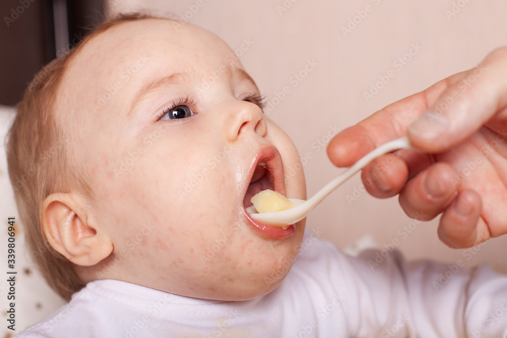 Children's food allergy on the face. One year old girl with red spots ...