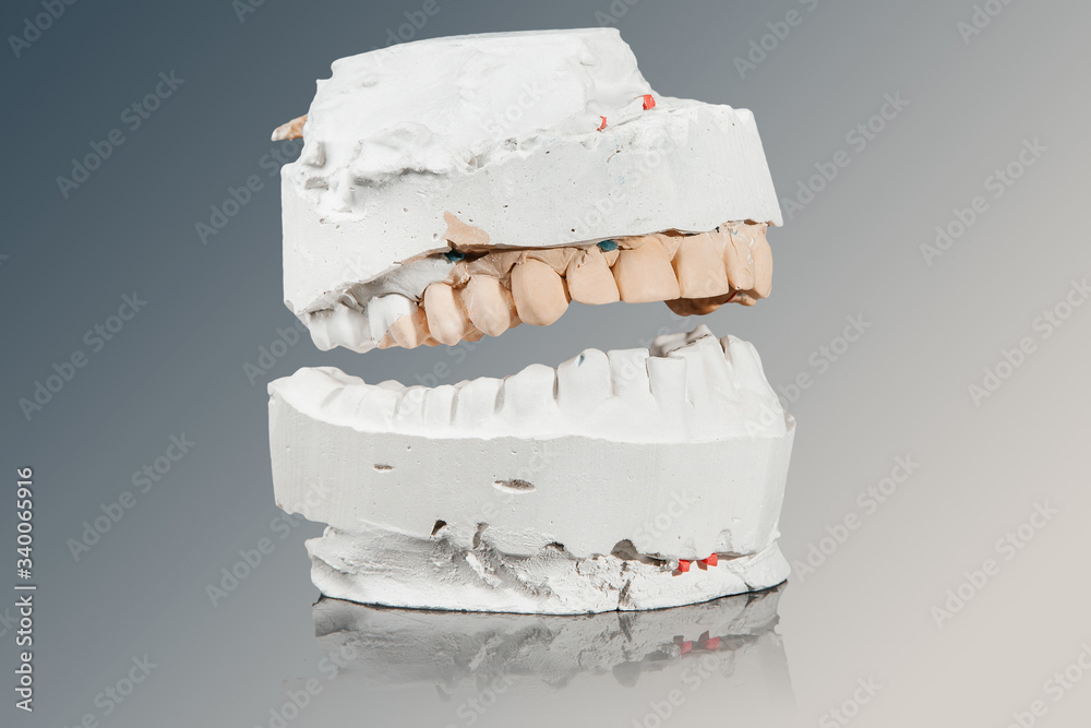 medicine, tooth, dentistry, impression, prosthesis, dentist, dental ...