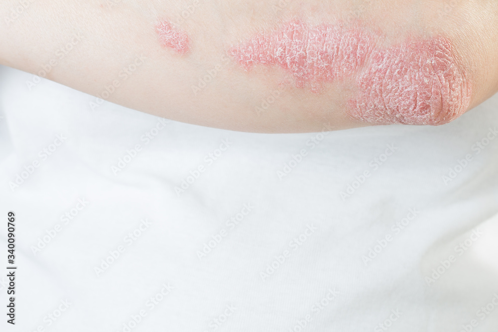 Acute Psoriasis On Elbows Is An Autoimmune Incurable Dermatological Skin Disease Large Red