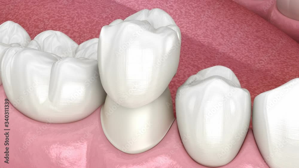 Preparated premolar tooth for dental ceramic crown placement. Medically ...