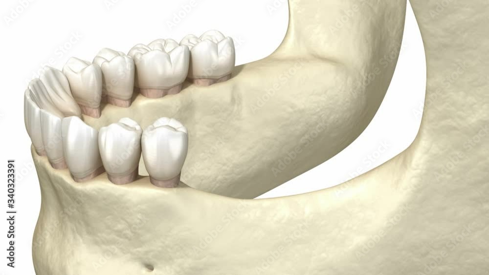 Cleavage of the alveolar ridge, augmentation, implantation. Dental ...
