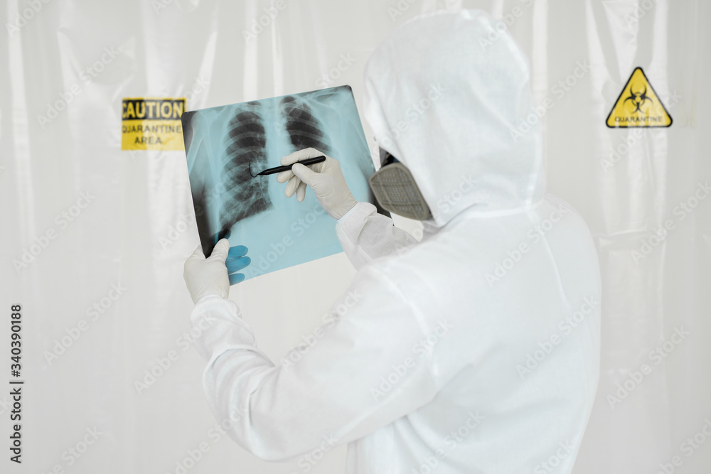 Epidemiologist draws a marker on the x-ray lung lesion covid-19 ...