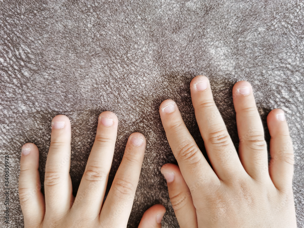 Bitten fingernails. Close up of hand with bitten finger and fingernails ...