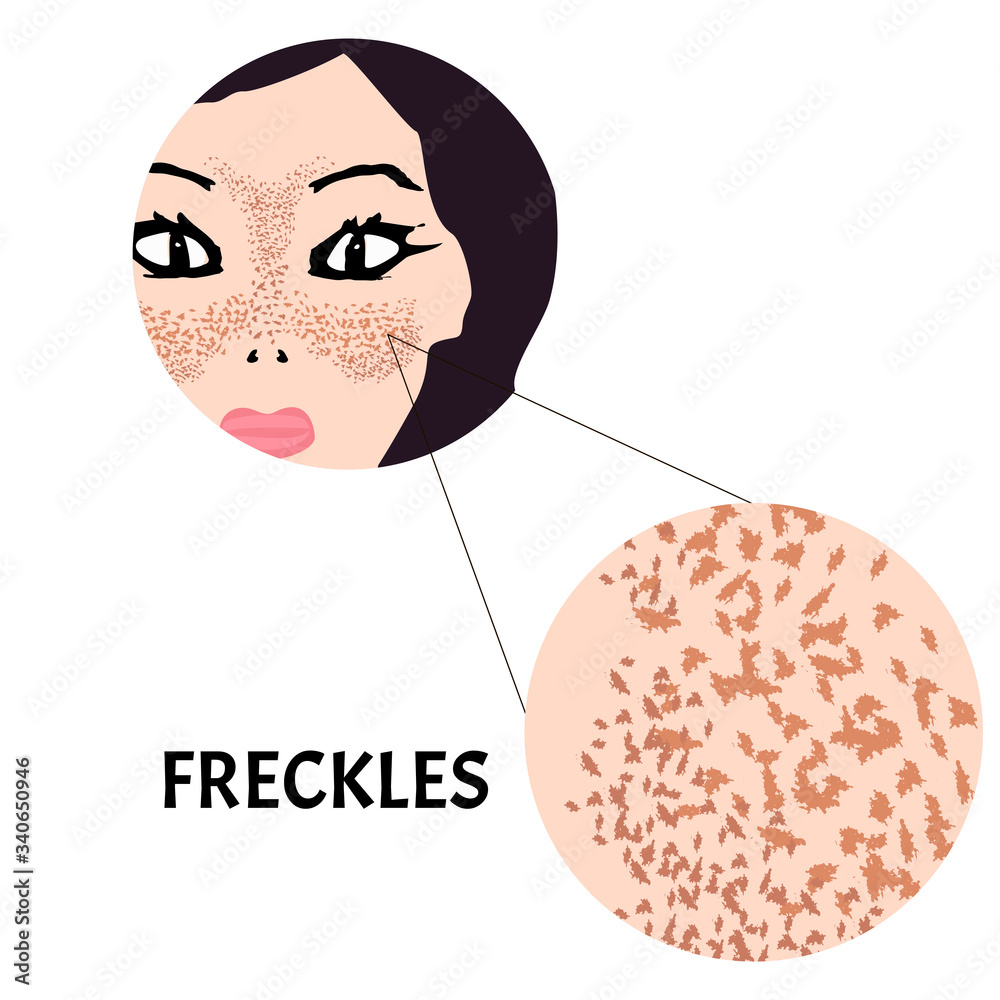 Freckles on the face. Pigmentation on the skin. A pigmented spot on the ...