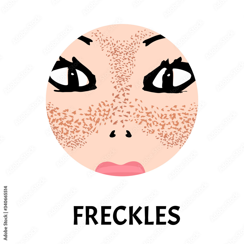 Freckles on the face. Pigmentation on the skin. A pigmented spot on the ...