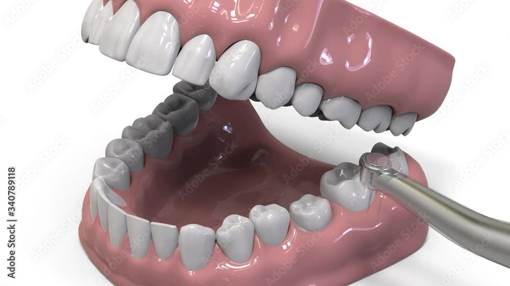 Dental golden crown placement for moral tooth, dental treatment ...