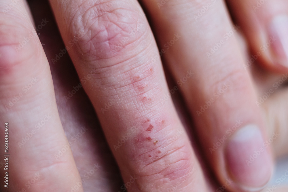 Skin diseases. Derma infection, eczema and psoriasis. Dermatology photo ...