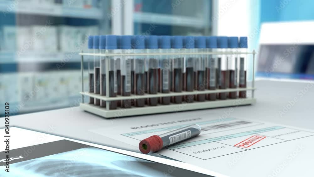Test tubes with a blood test and lungs x-ray image in the scientific ...