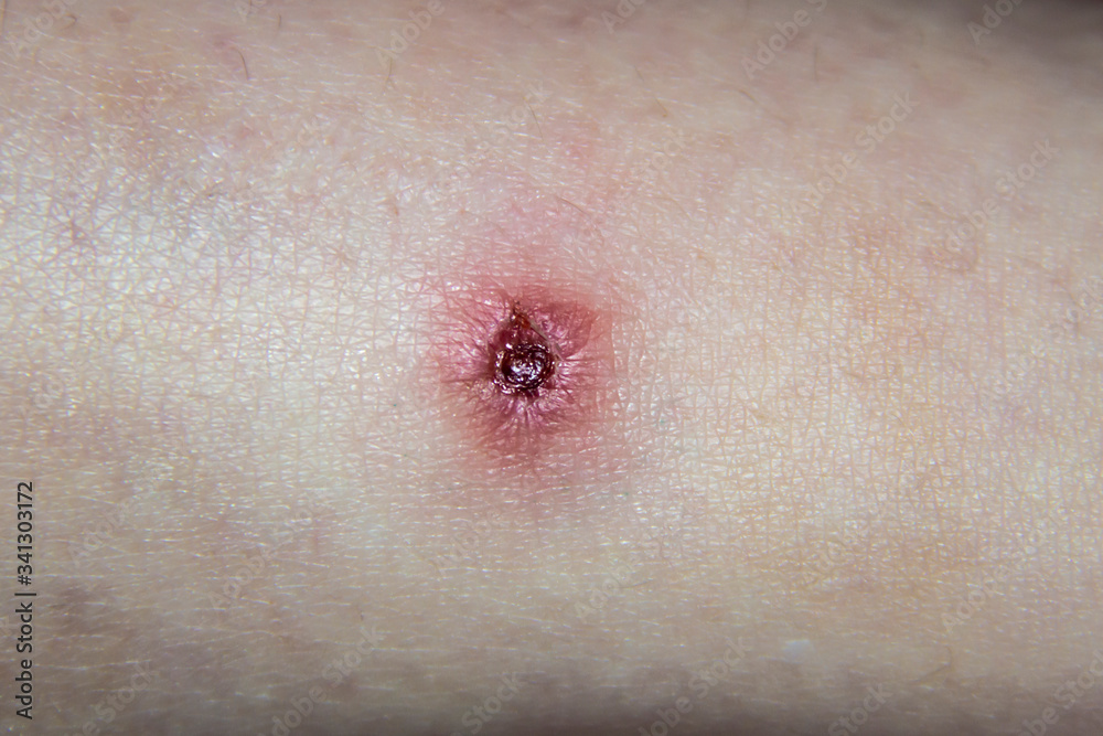 Torn wound from inflammation, acne on the human skin. Red infected ...