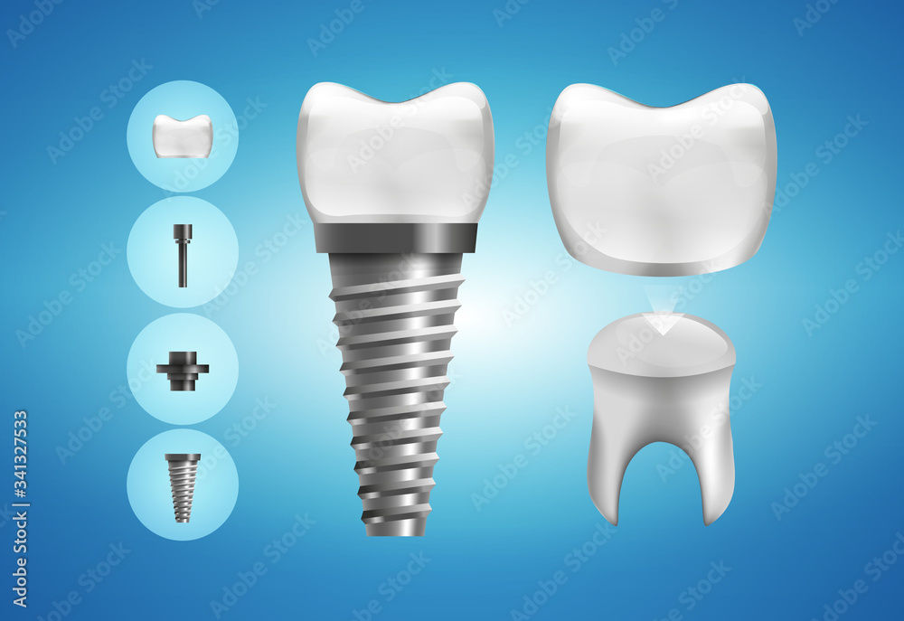 Dental implant structure and Crown restoration in realistic style ...