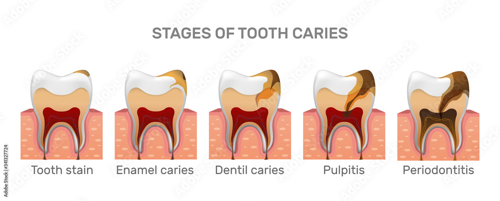 Tooth caries structure and full placement steps in realistic style ...