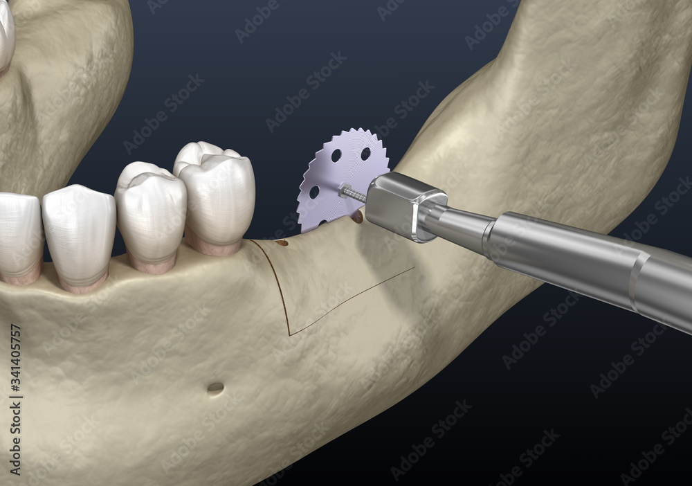 Cleavage of the alveolar ridge, augmentation. Dental surgery, 3D ...