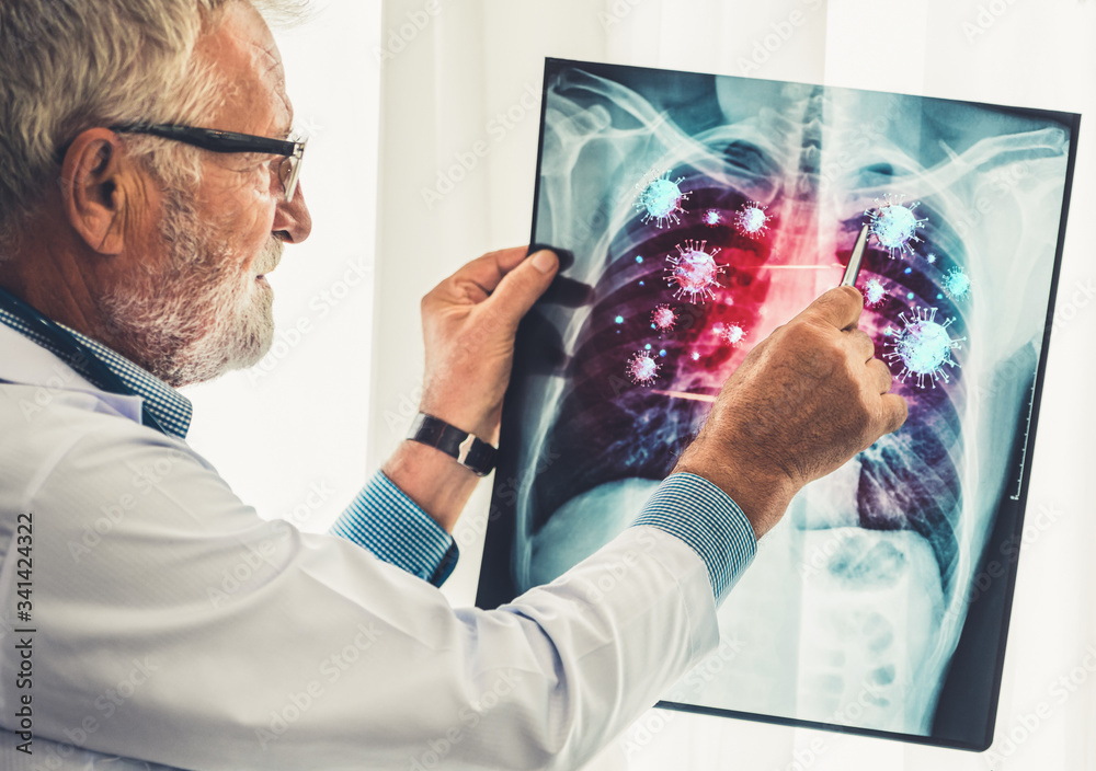 Doctor analyze Coronavirus Disease 2019 or Covid-19 displayed on x ray ...