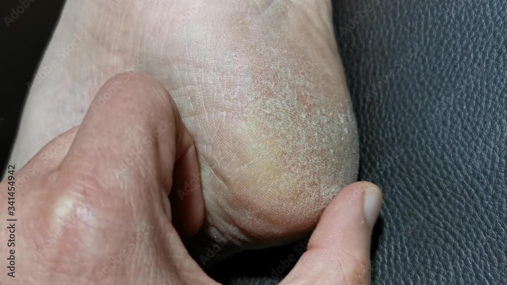 Closeup with details on the sole of a very rough foot with dead hard ...