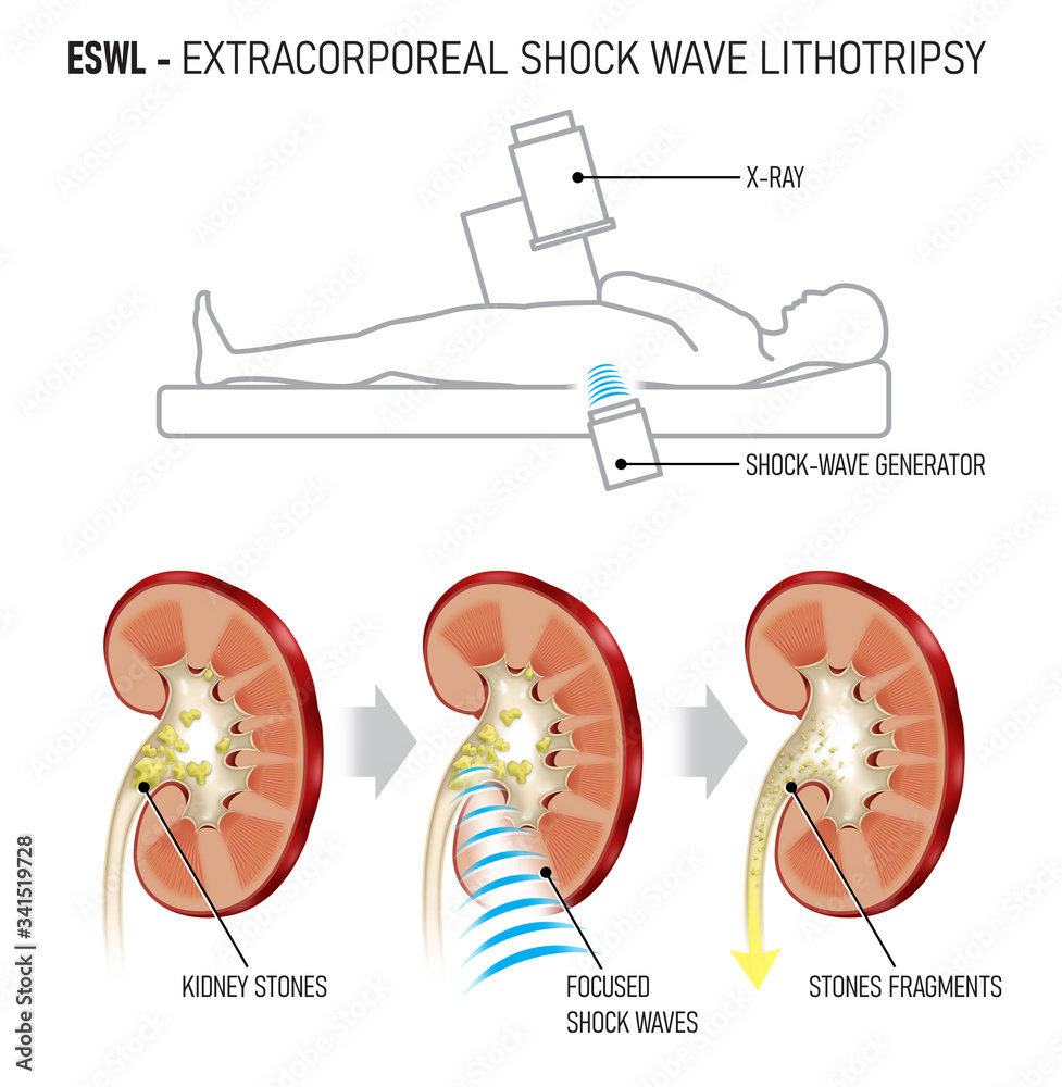 Extracorporeal shock wave lithotripsy (ESWL) for kidney stones. shock ...