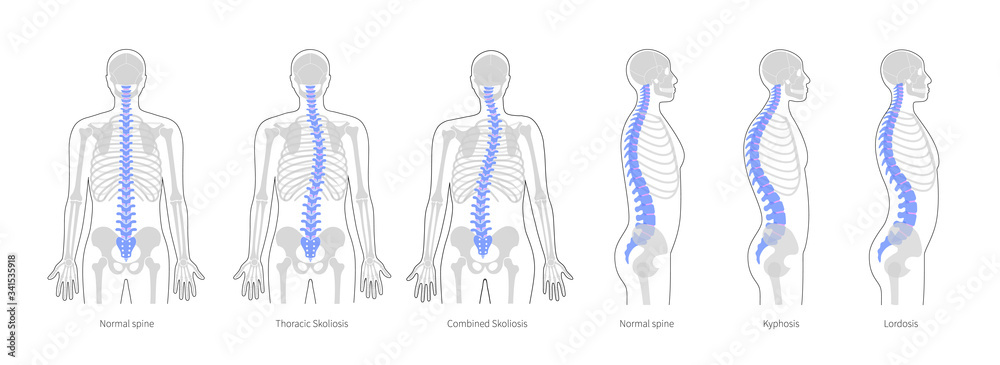 Spinal deformity flat vector illustration Stock Vector | Adobe Stock