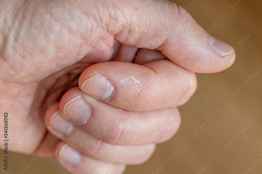 Hands damaged by disease of the skin. The skin on your hands will crawl ...