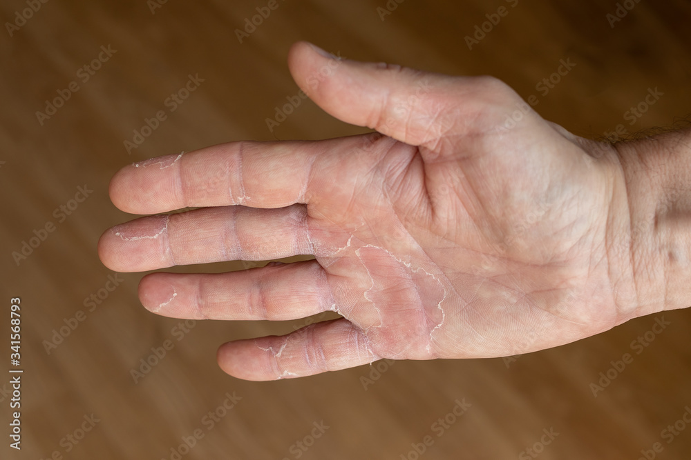 Hands damaged by disease of the skin. The skin on your hands will crawl ...