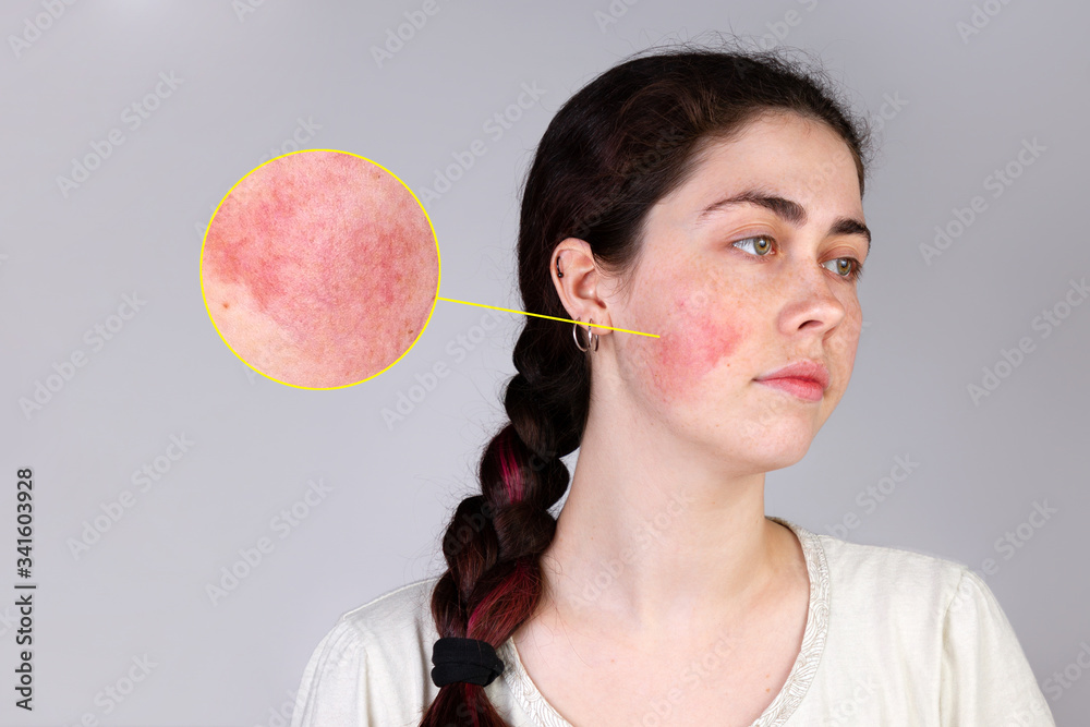 The concept of rosacea. A young Caucasian woman shows off a red cheek ...
