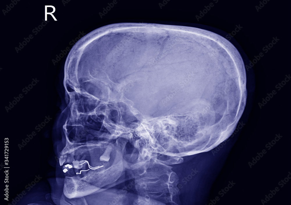 X-ray skull Finding The cranial vault is intact.No abnormal intra ...