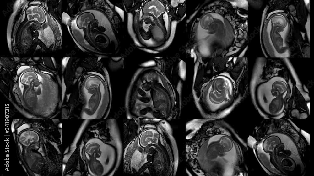 tock footage embryo, fetus, germ, foetus, fetus, nucleus, egg, foetus ...