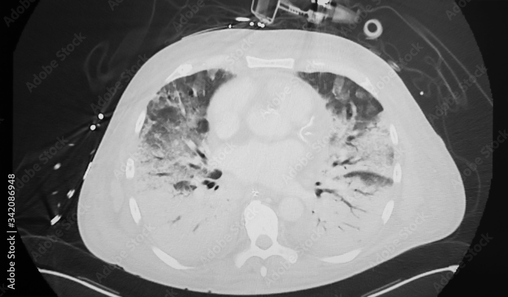 CT scan of a patient with COVID-19 Stock Photo | Adobe Stock