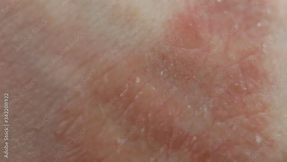 Stockvideon The affected skin is extremely close-up, real time ...