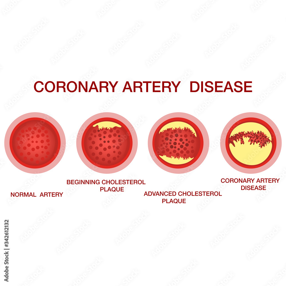 Coronary artery disease concept. Healthy and narrowed arteries with ... Coronary artery disease concept. Healthy and narrowed arteries with ...