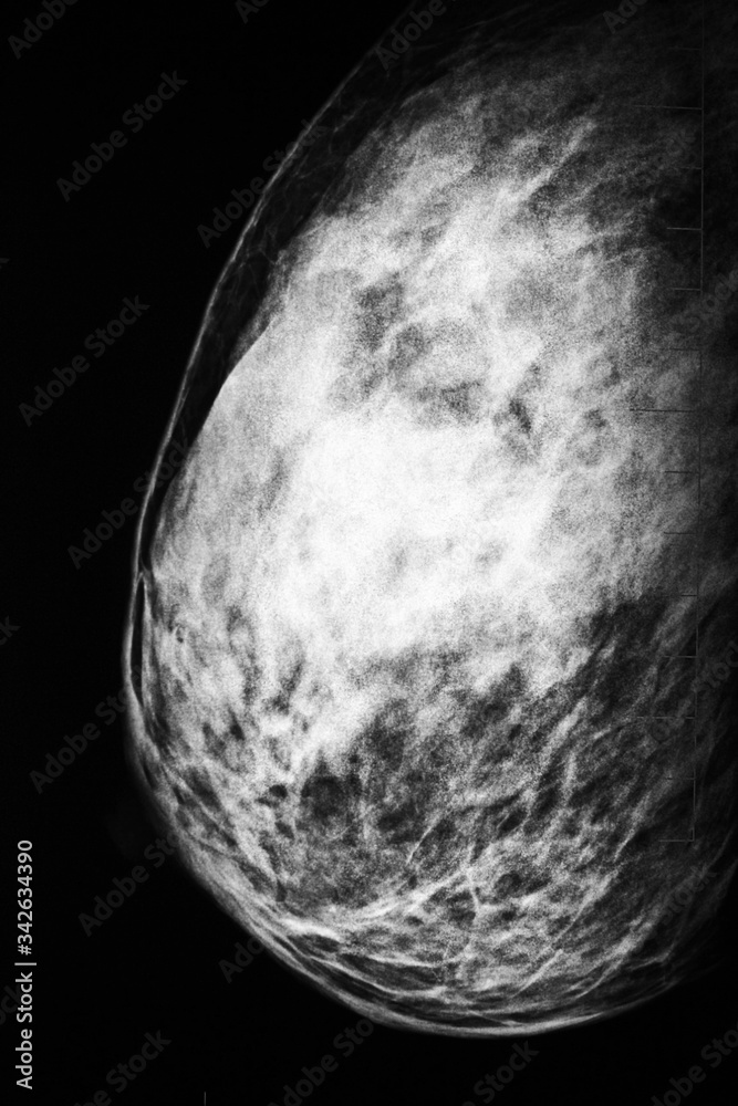 X-ray of a female breast Stock Photo | Adobe Stock