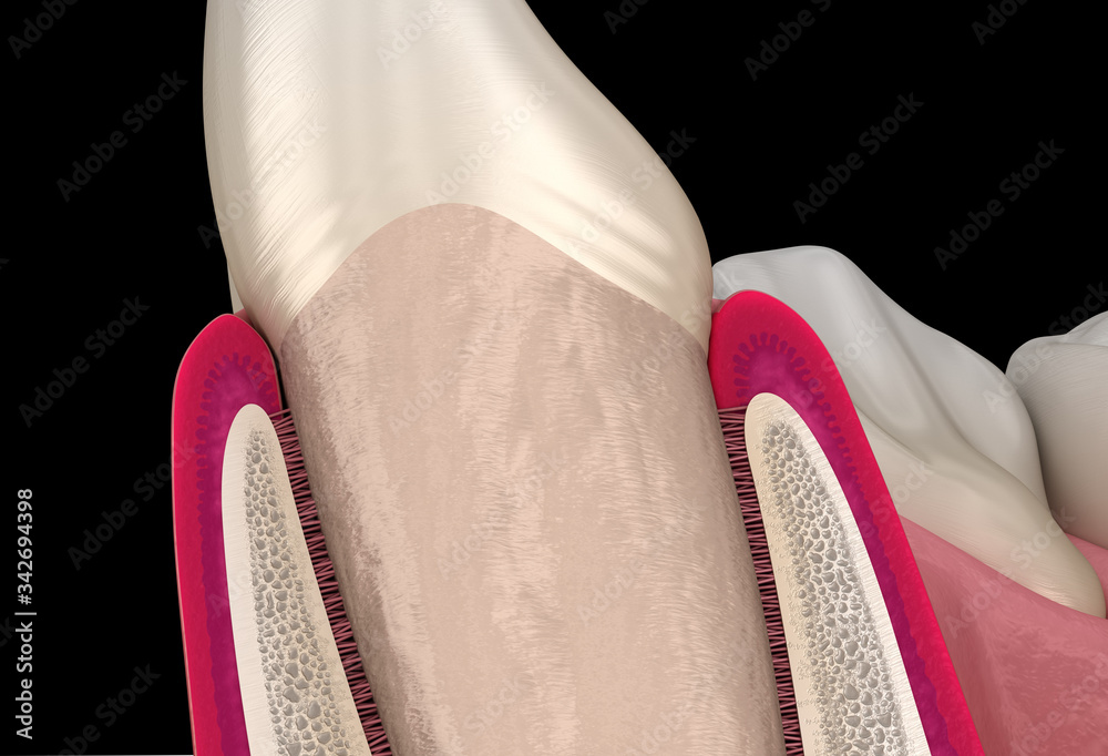 Fotografie, Obraz Morphology of maxillary lateral incisor tooth and gum ...