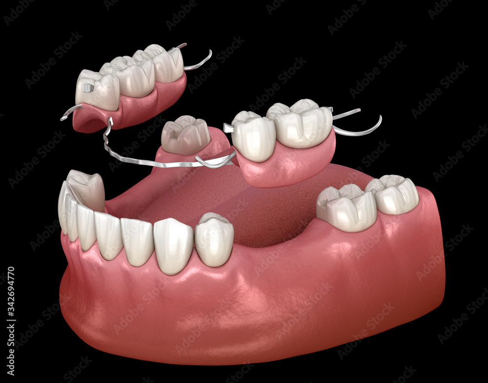 Póster Removable partial denture, mandibular prosthesis – Cuadro para ...