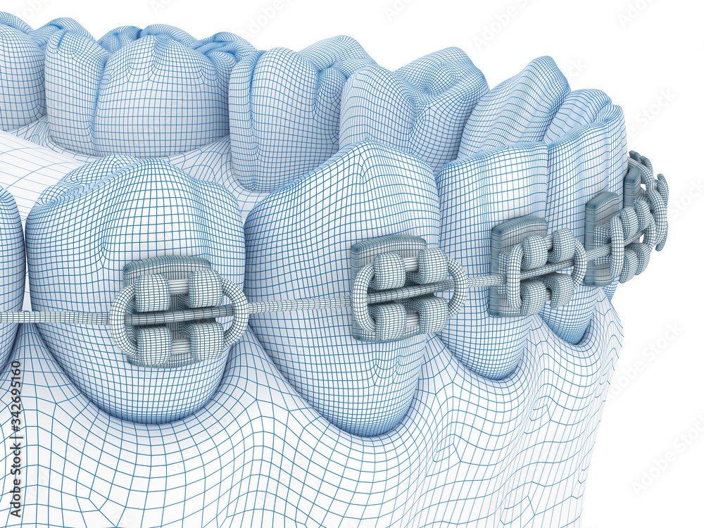 Braces and denture. Wire 3d model illustration Stock Illustration ...