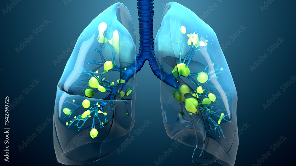 Damage lungs, severe respiratory illness, pneumonia, ARDS, acute ...