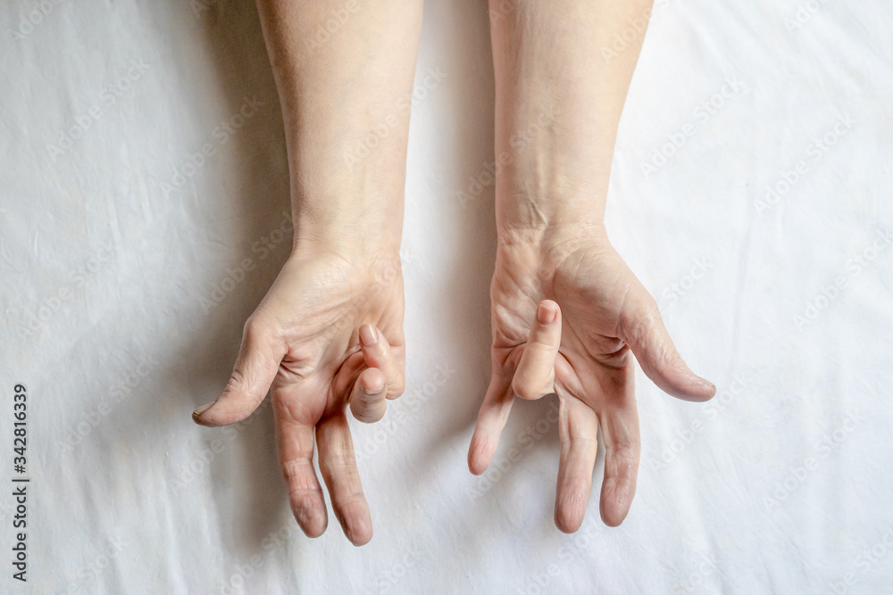 Hands of a woman with twisted fingers. Dupuytren's contracture disease ...