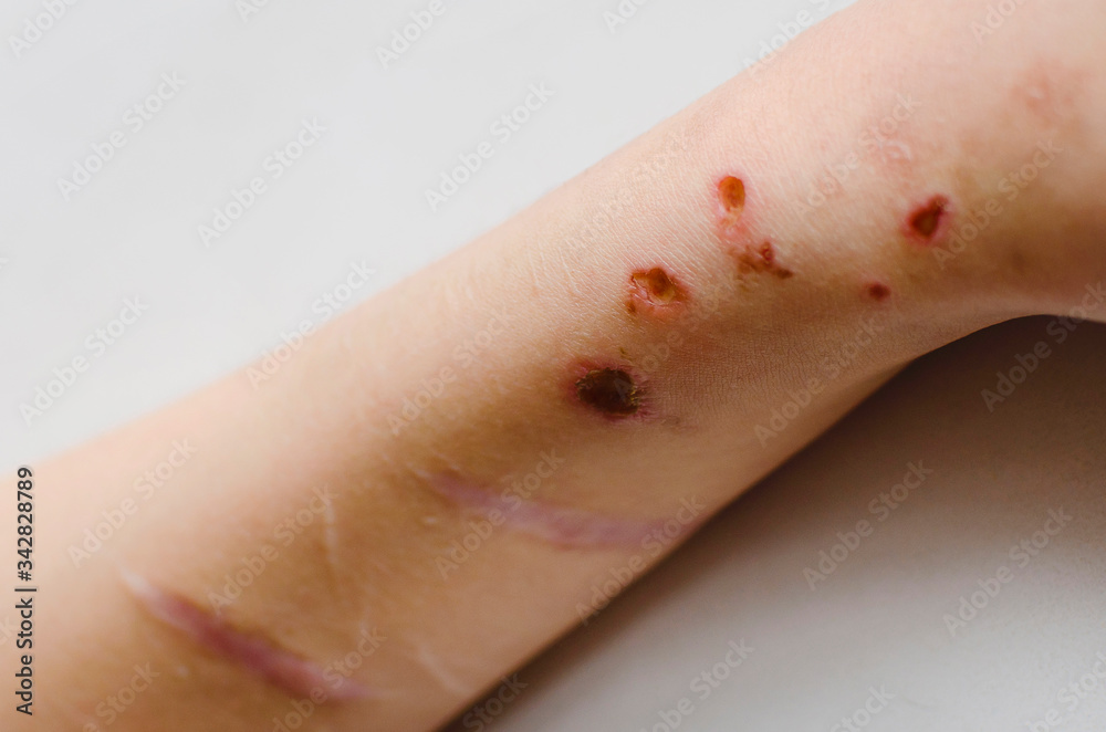 The wound form scabs on hand and arm. Close-up. foto de Stock | Adobe Stock