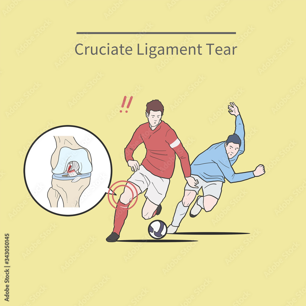 Cartoon medical illustration for explaining anterior cruciate ligament ...