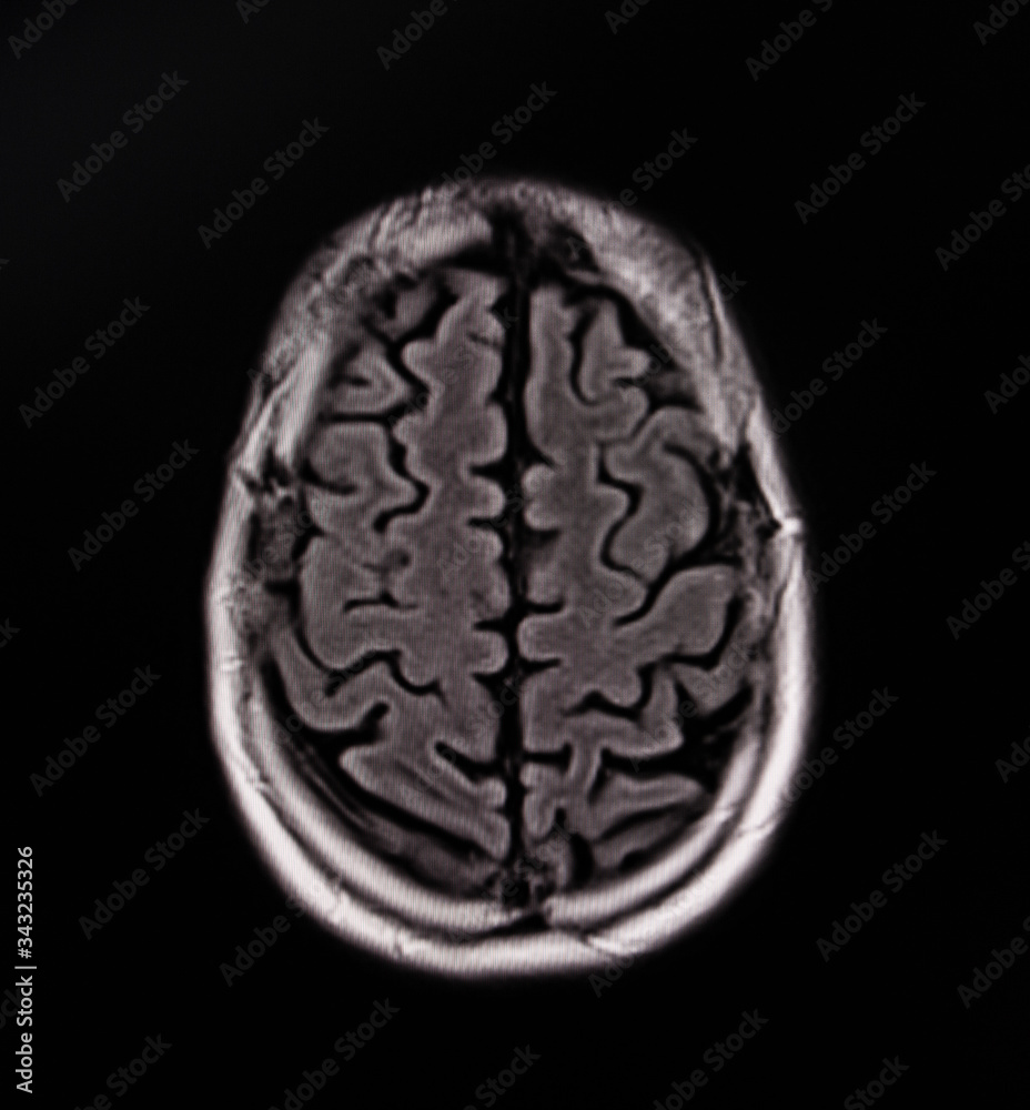 MRT images of a human brain Stock Photo | Adobe Stock