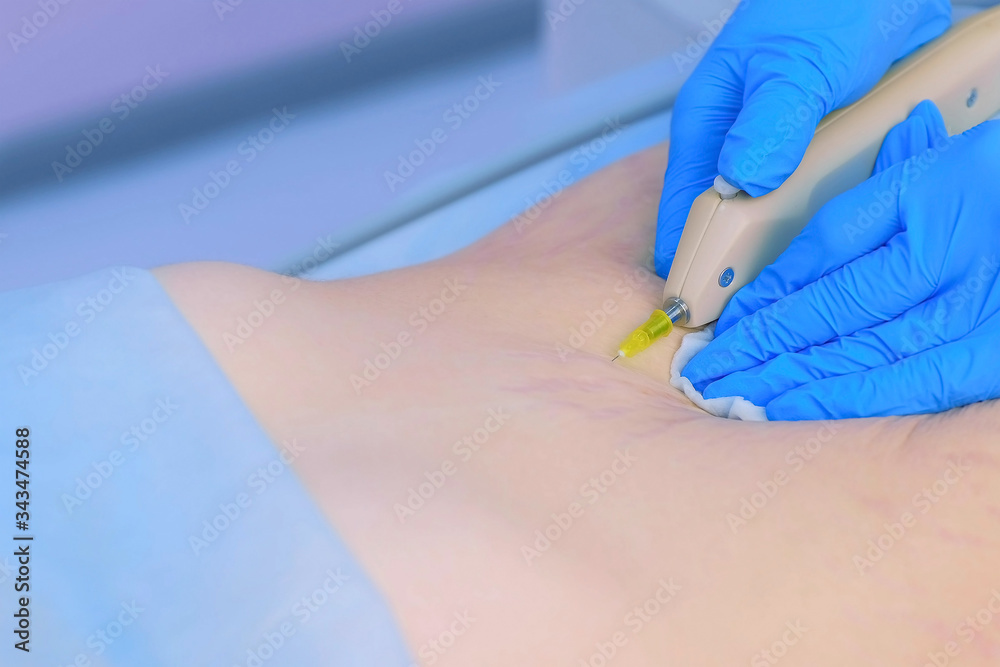 Doctor making injection of carbon dioxide on patient abdomen on ...