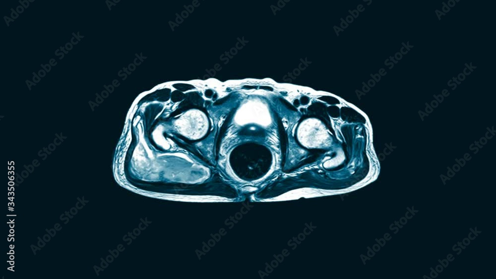 Magnetic Resonance Imaging (MRI) of both hip sagittal plane. Finding A ...