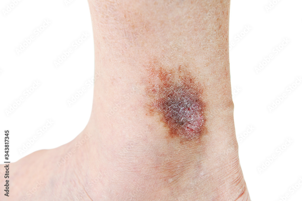 Atopic dermatitis (AD), also known as atopic eczema, is a type of ...