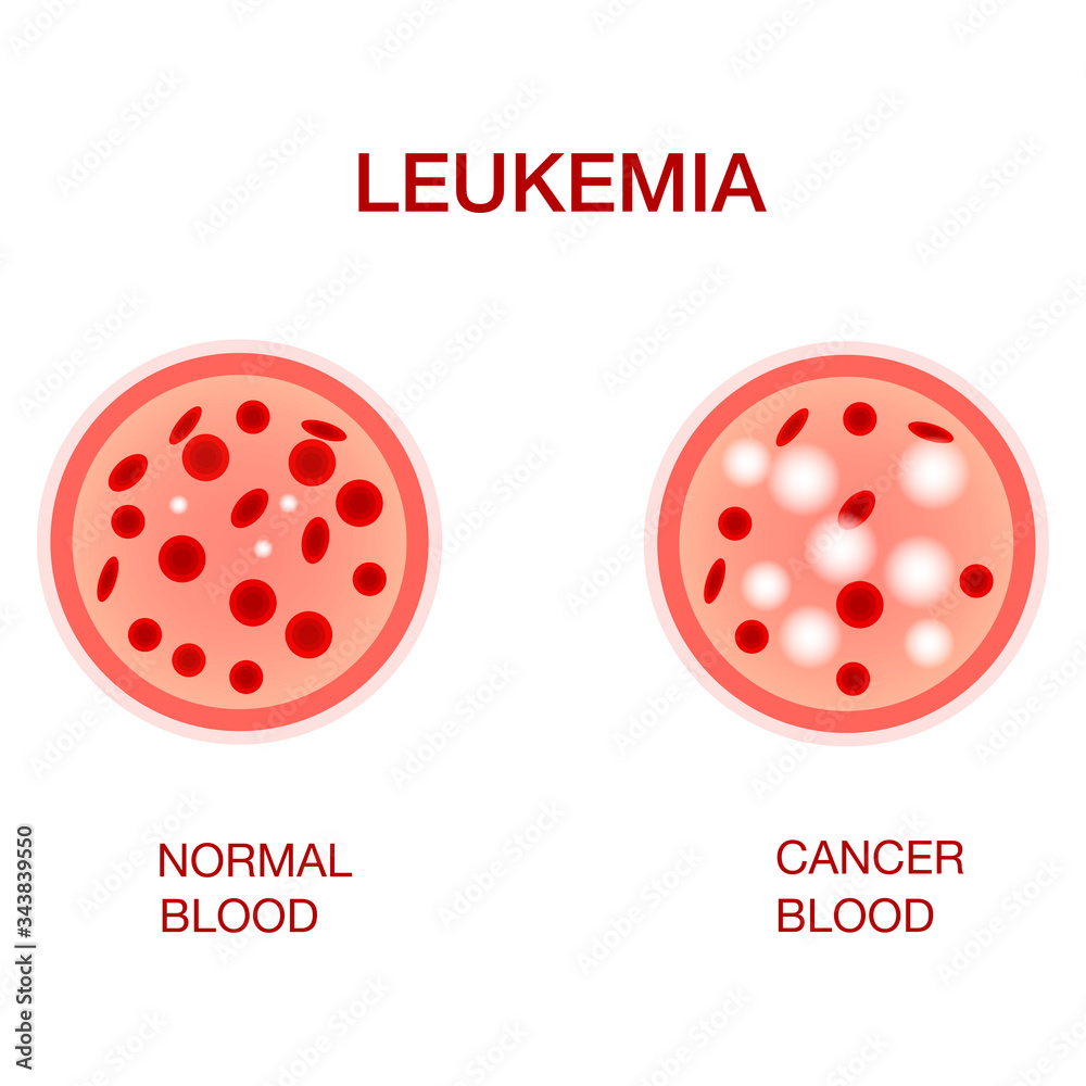 Infographic image of leukemia. Leukaemia disease awareness.Leukemia ...