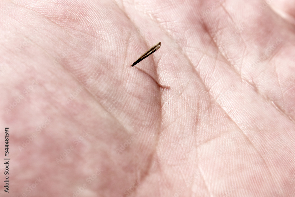 Splinter palm skin. Hand background for medical remove spike. Stock ...