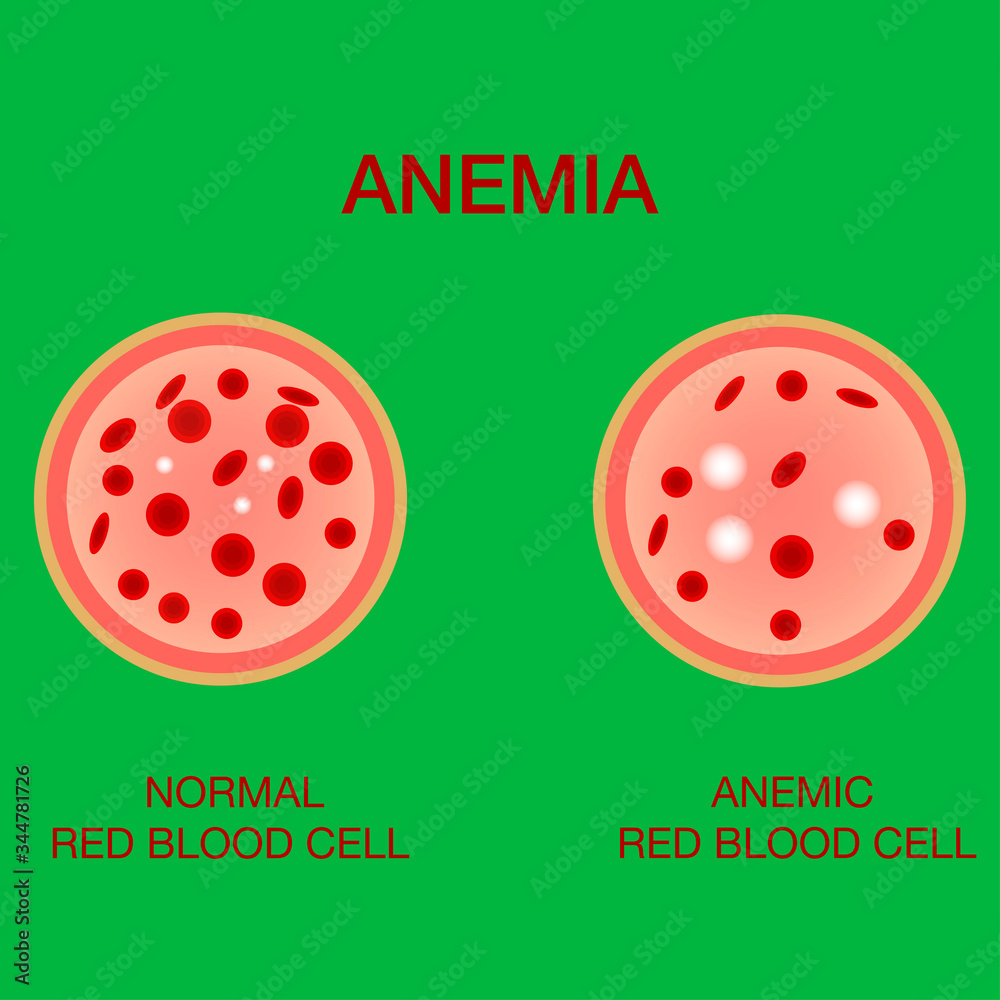 Infographic image of anemia .The difference of Anemia amount of red ...