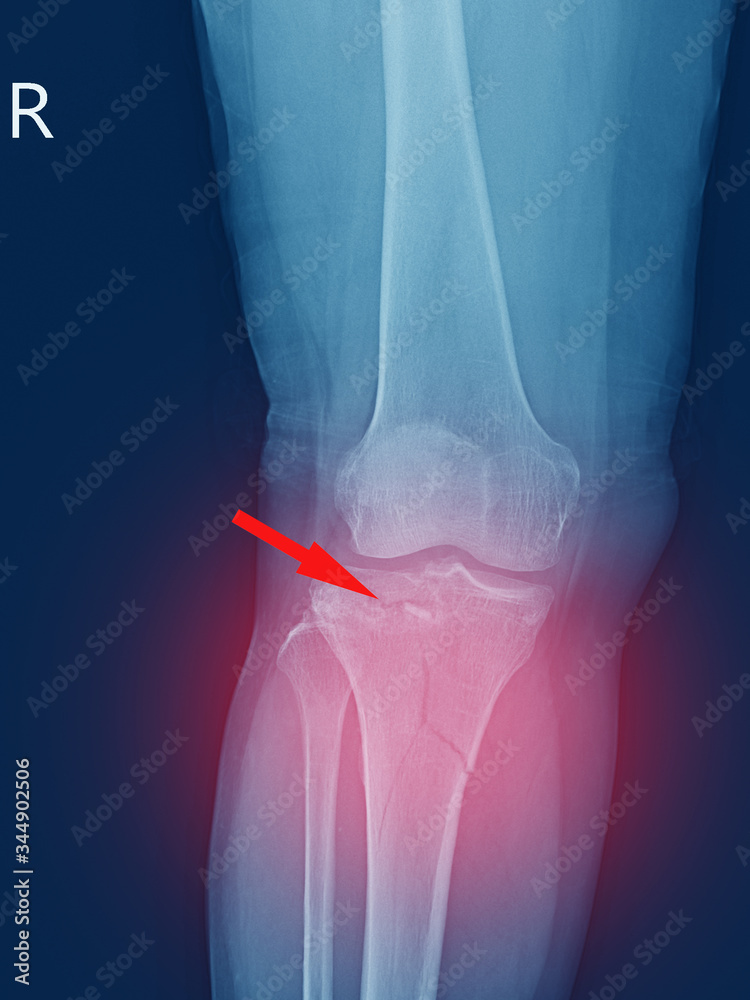 X-ray knee Fracture proximal metaphysis of tibia.Depressed fracture of lateral tibial plateau ...
