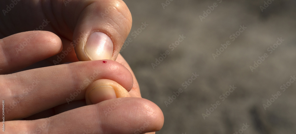 Damage to the skin on the finger, a drop of blood from a puncture on ...